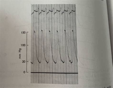 Hemo Abnormal Arterial Waveforms Flashcards Quizlet