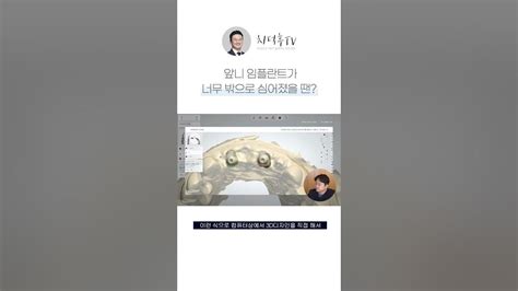 Shorts 앞니 임플란트가 너무 밖으로 심어졌을 땐 Youtube