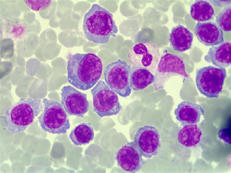 Circulating Plasma Cells As Evident On The Peripheral Smear 1000× In Download Scientific