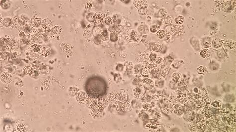 Pus Cells In Stool Microscopypus Cells How To Differentiate From