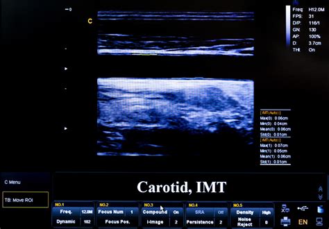 Cimt Carotid Intima Media Thickness Test
