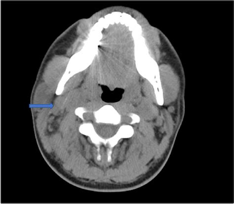 Level Ii Cervical Lymphadenopathy In Ct Soft Tissue Neck Download Scientific Diagram
