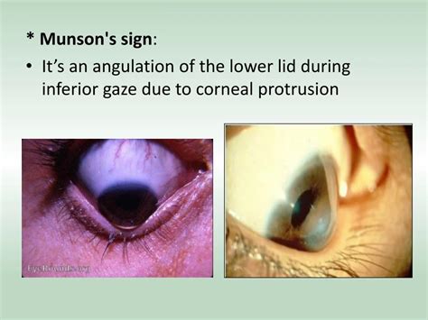 Ppt Diseases Of The Cornea 0 Corneal Ulcer 1 Infections
