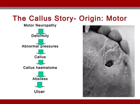 Diabetic Microvascular Complications Ppt