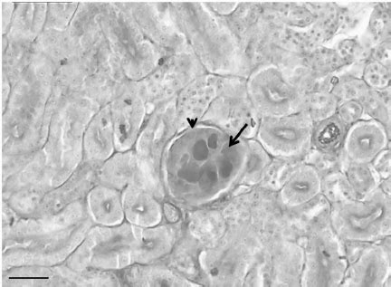 Glomerular Sclerosis Arrow And Adhesions Arrowhead To Bowmans Download Scientific Diagram