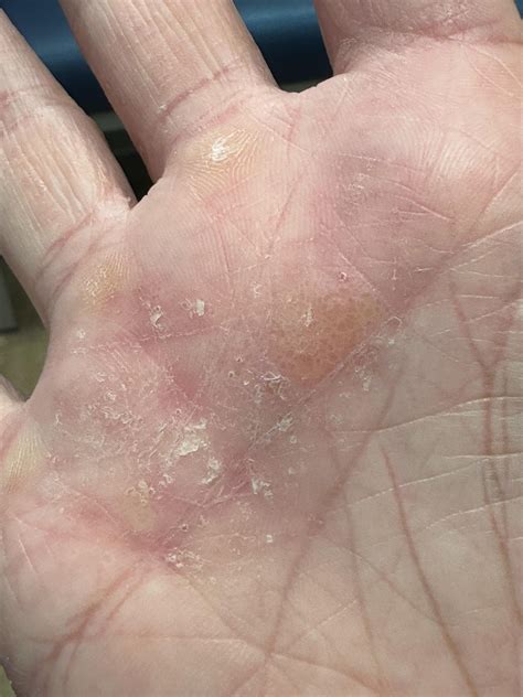 Also Known As Acute Vesiculobullous Hand Eczema Dyshidrotic Eczema