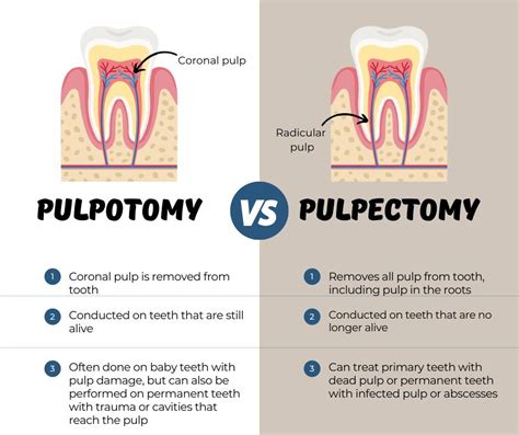 Pulptomy Vs Pulpectomy Do You Know Dr Paul Loper Dds