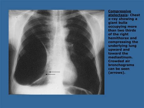 Ppt Atelectasis Powerpoint Presentation Id6185976