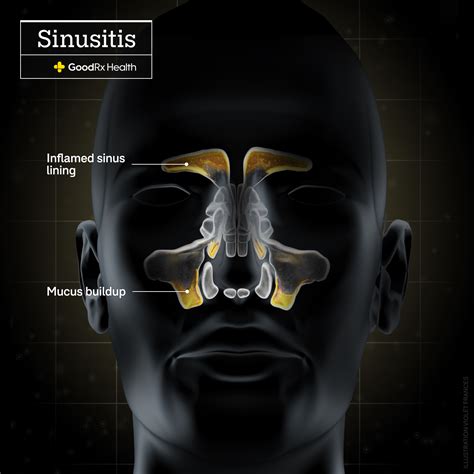 Are Sinus Infections Contagious Goodrx