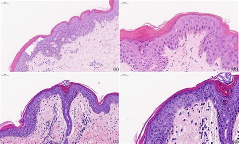 Full Article Clinical Characteristics Of Granular Parakeratosis Caused By Benzalkonium Chloride