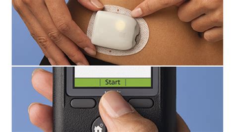 Инсулиновая помпа Insulet Omnipod теперь интегрируется с системами контроля сахара Dexcom и Abbott