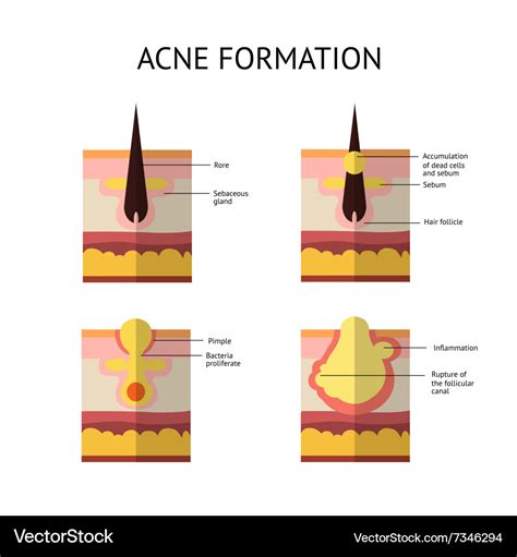 Sebaceous Gland Acne