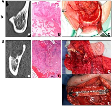 Vertical Mandibular Invasion And Operation Methods Of Lower Gingival