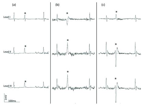 Representative Ectopic Beats Recorded In Mice Using Lead I Ii And Iii