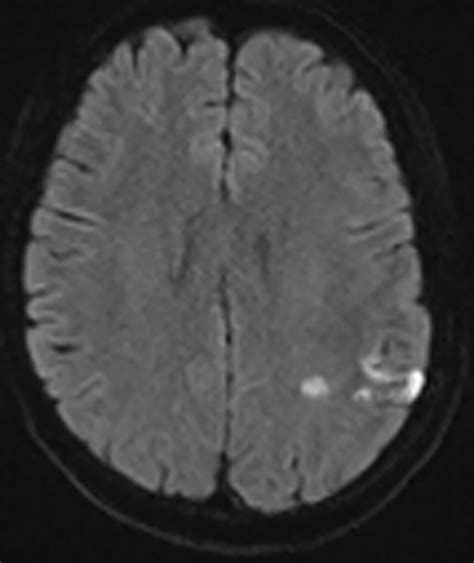 Diffusion Weighted Imaging Of The Superior Cerebral Hemispheres