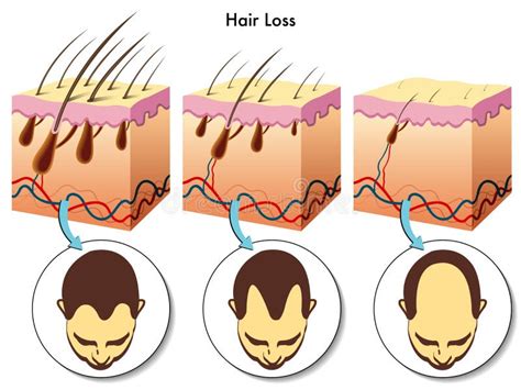 Hair Loss Stock Vector Illustration Of Hair Hormones 25563603