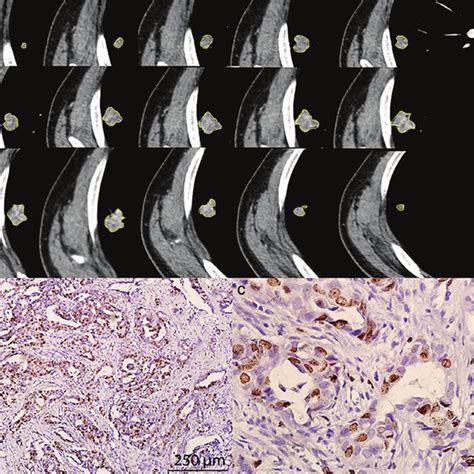 Examples Of Segmentation Of Lung Cancer Based On Contrastenhanced Download Scientific Diagram