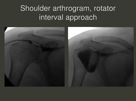 Ppt Anatomy And Pathology Of The Rotator Interval Powerpoint Ppt Anatomy And Pathology Of The Rotator Interval Powerpoint