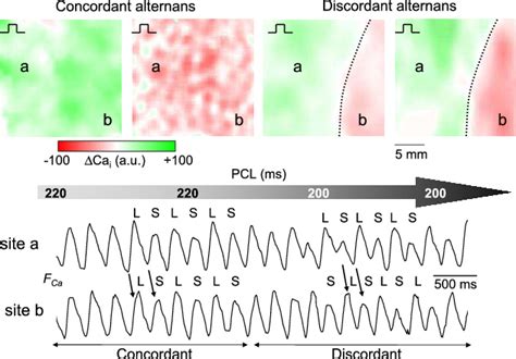 Spatially Concordant And Discordant Cai Transient Alternans During