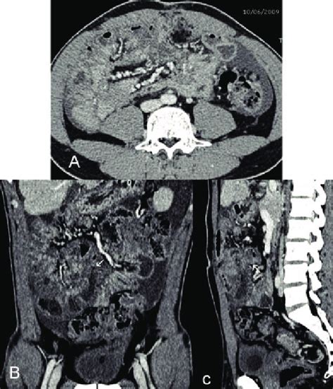 Ct Scan In A 29 Year Old Man With History Colonic Cancer At Hepatic