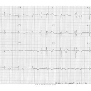 The Electrocardiogram Showed Atrial Fibrillation The QT Interval Was Download Scientific