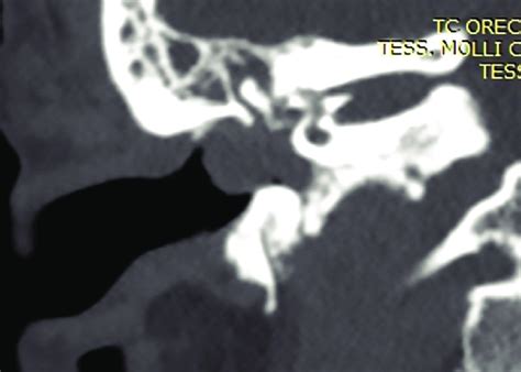 Right Ear CT Scan Coronal View Download Scientific Diagram