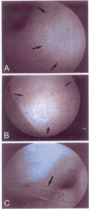 Arthroscopic Imaging Of Chondral Defects 15 Weeks Following Surgery Download Scientific
