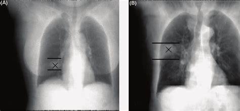 Reconstructed Breathing Cycles For Two Lung Tumor Patients A Female Download Scientific