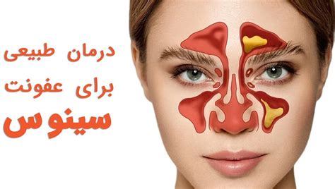 غلبه بر عفونت سینوس ترفندهای ساده و موثر بدون نیاز به دارو اینفوگرافی