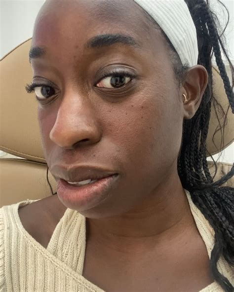 Moxi Laser Review Before And After Photos Benefits And Cost