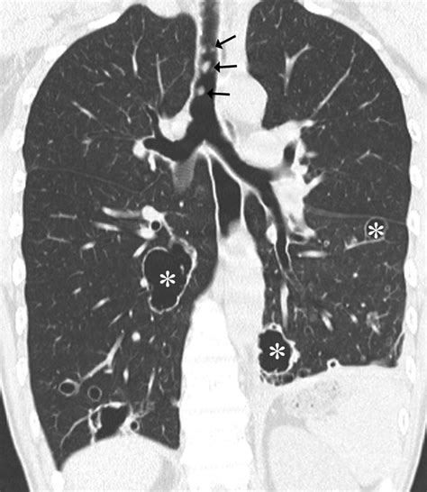 Respiratory Papillomatosis