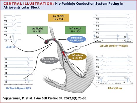 Conduction Block Treatment At Lisa Wolf Blog