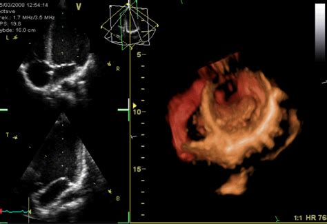 Right Ventricular Function 2 Echocardiographic Assessment Online Learning