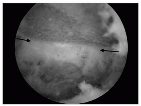 Complications Of Arthroscopic Subacromial Decompression And Acromioclavicular Joint Resection
