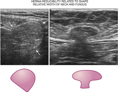Dynamic Ultrasound Of Hernias Of The Groin And Anterior Abdominal Wall