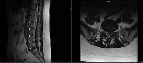 A 17 Year Old Patient With One Pathologic Level And Excellent Download Scientific Diagram