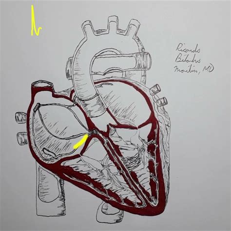 Atrial Flutter With Variable Av Block Explained In 40 Seconds Youtube