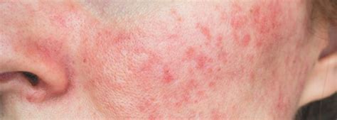 Rosacea Types Causes And Treatments Southwest Florida S Health And Wellness Magazine
