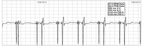 What Is Mvp Mode In Medtronic Pacemaker System