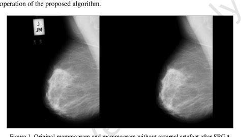 Figure From Registration Orientation And Edge Detection From Digital Mammogram Images