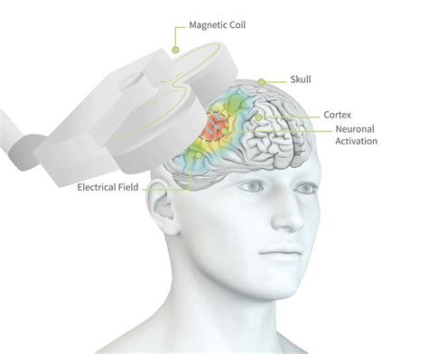 Rtms Behandeling Aanbevolen In Nieuwe Depressie Richtlijn