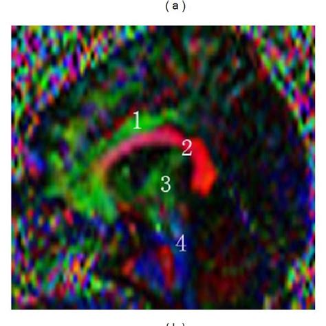 transversal fa map color tensor map and sectional image of visible