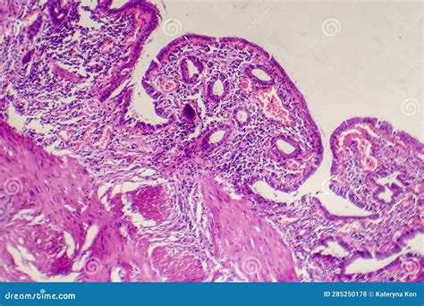 Chronic Cholecystitis Light Micrograph Stock Image 122813083