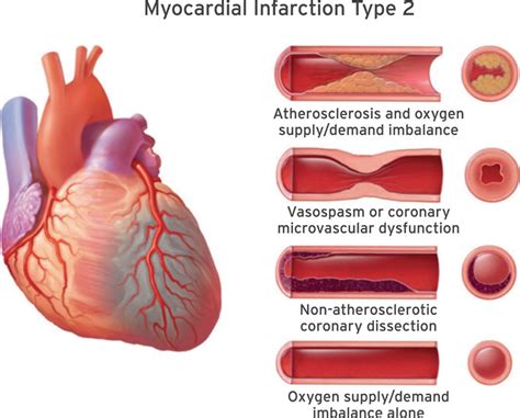 Myocardial Infarction Symptoms