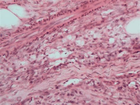 Accompanied By Capillary Endothelial Hyperplasia Further Away In