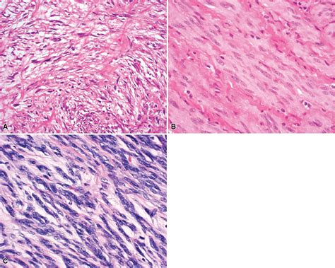 Sarcomas And Sarcomatoid Neoplasms Of The Lungs And Pleural Surfaces Clinical Tree