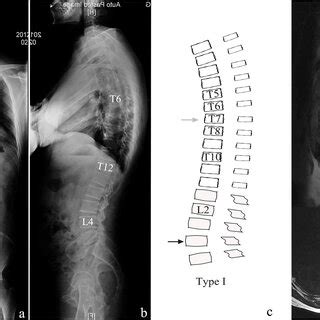 A 50 Year Old Man Classified As Type Ii A Anterior Posterior Whole