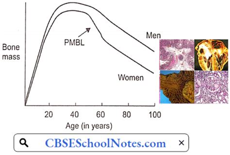 Bone Diseases Types Symptoms And Treatments CBSE Babe Notes