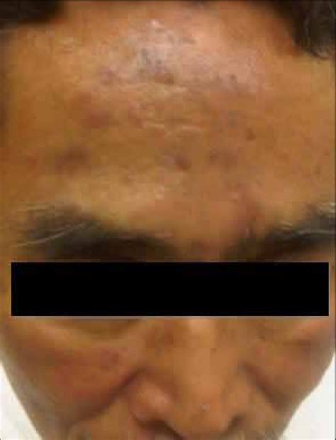 Photograph Shows Diffuse Rash Developed By The Patient After Taking Download Scientific Diagram