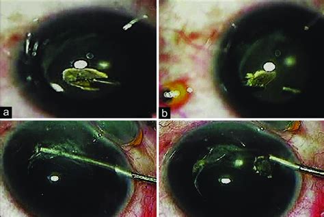 Metallic Intraocular Foreign Body Was Retrieved Just Behind The